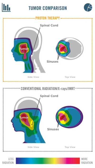 Proton Therapy for Head & Neck Cancer - Covenant Health