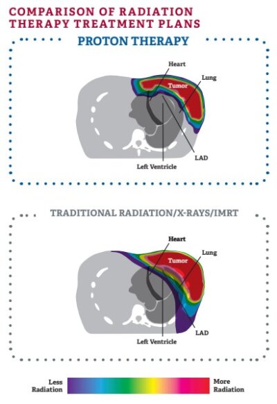 Proton Therapy for Breast Cancer - Covenant Health